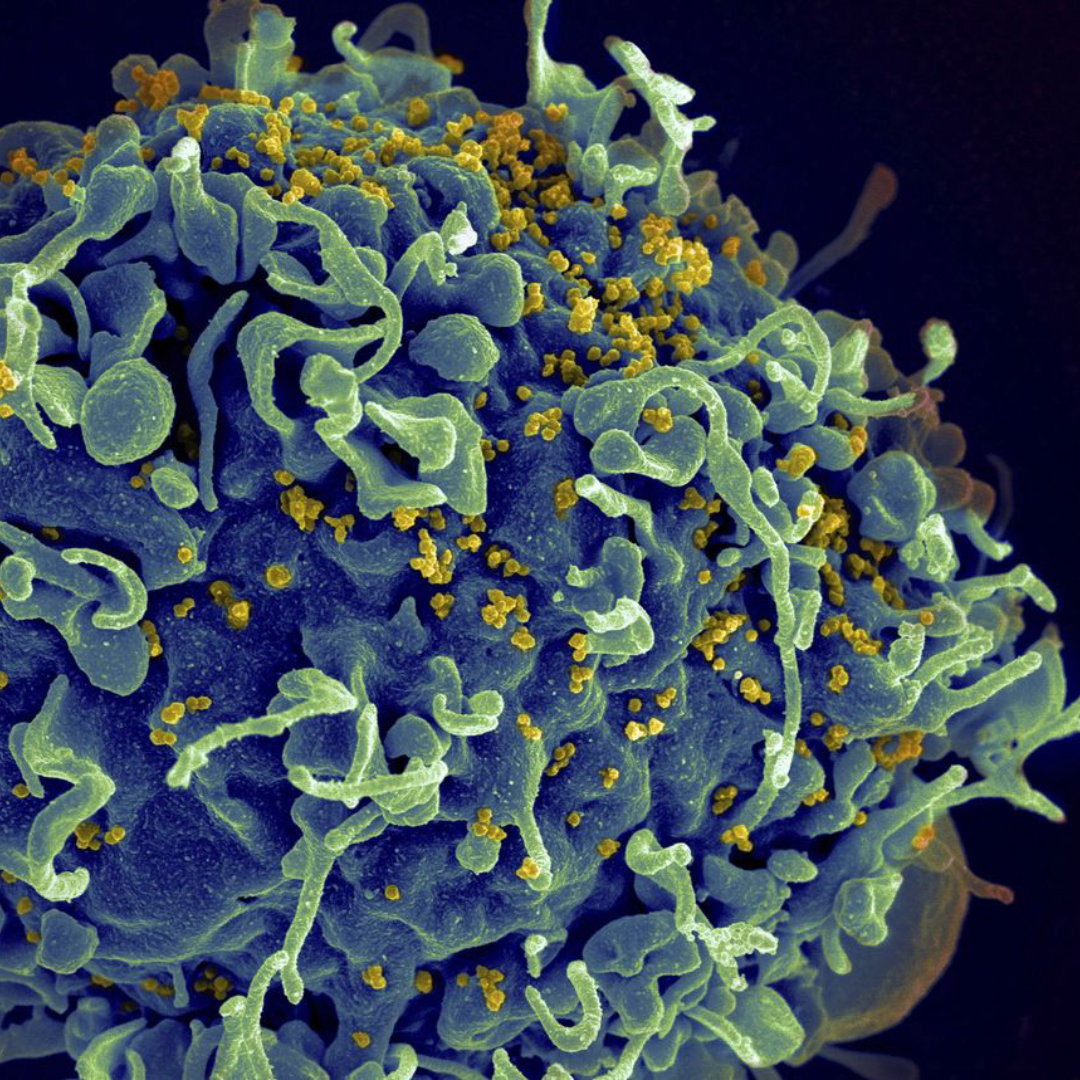 First case of HIV cure in a woman after stem cell transplantation ...