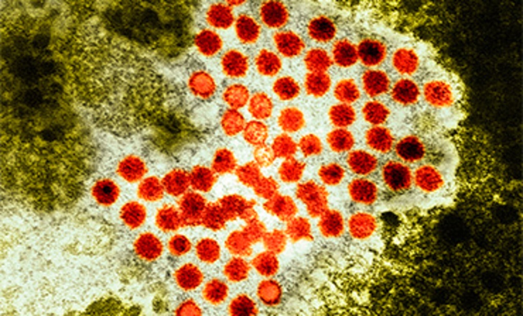 Hepatitis A