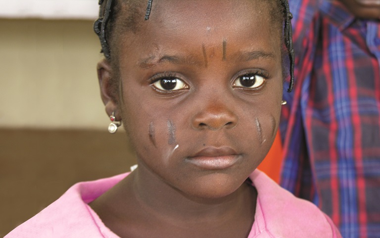 Язва Бурули (инфекция бактерией Mycobacterium ulcerans)