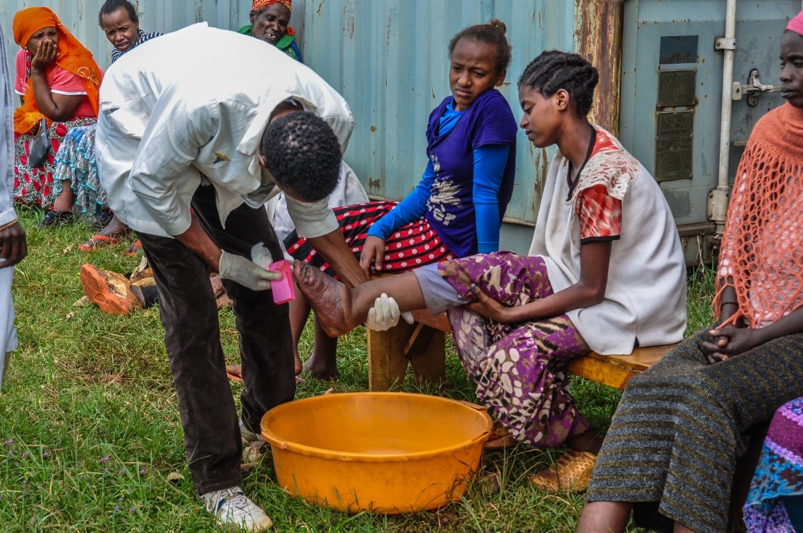 Podoconiosis (non-filarial lymphoedema)