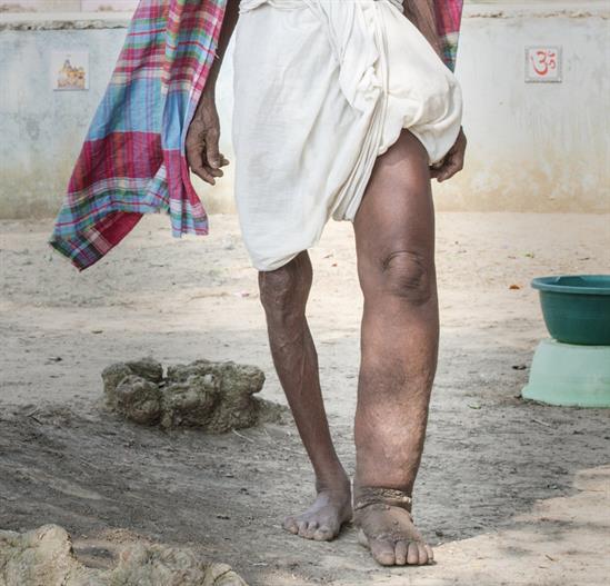 Lymphatic filariasis (Elephantiasis)
