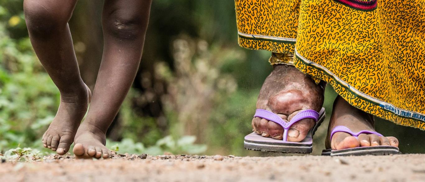 Lymphatic filariasis (Elephantiasis)