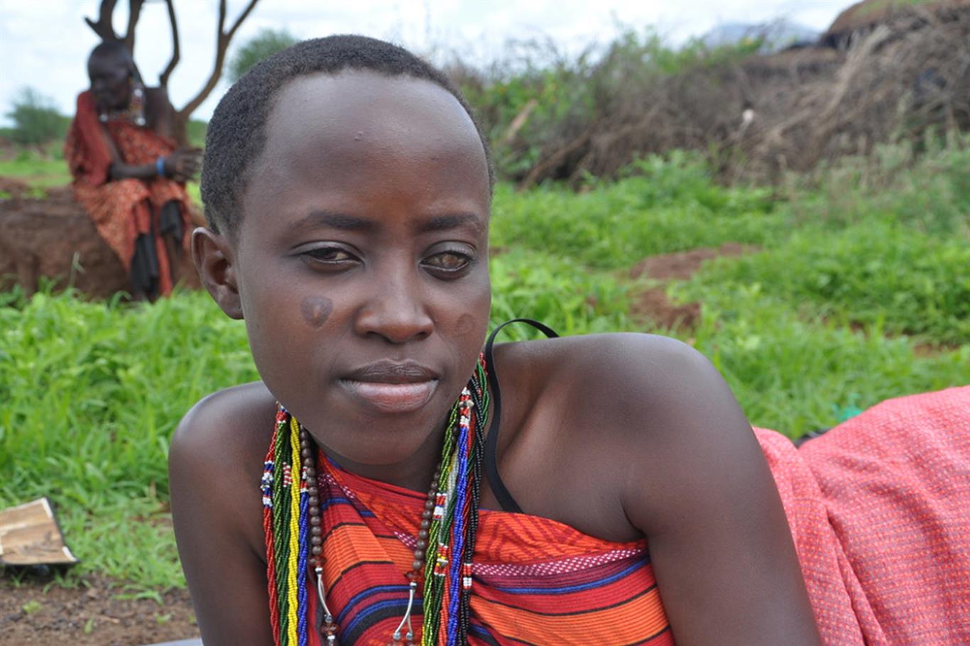 Onchocerciasis (river blindness)