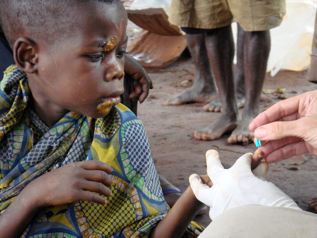 Yaws (Endemic treponematoses)